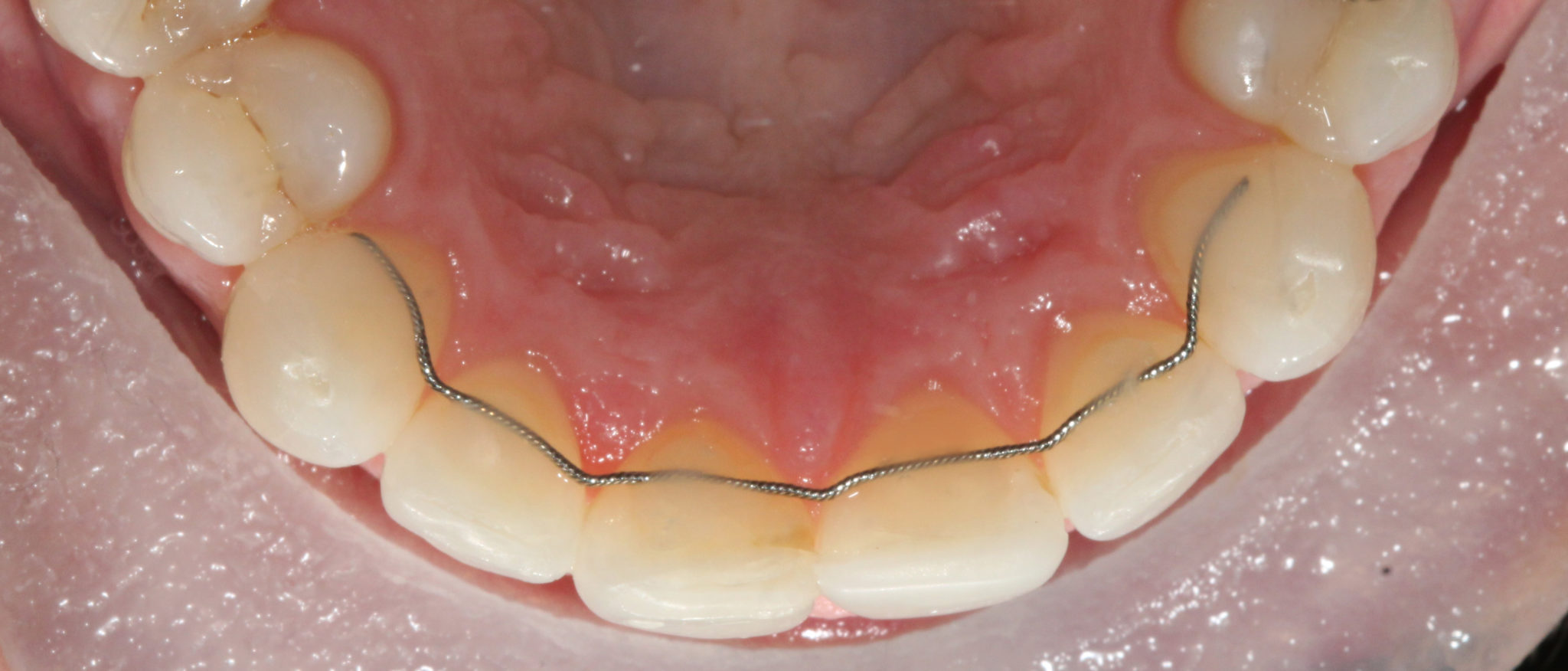 Fixed Orthodontic Retainer